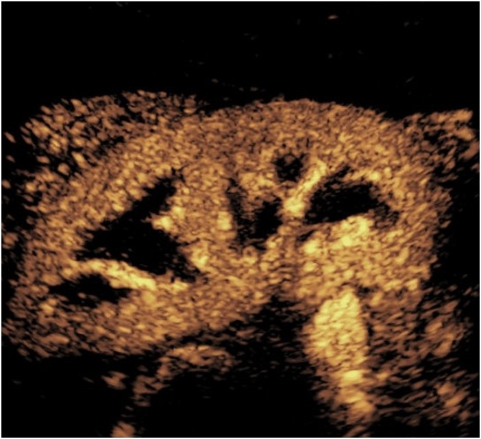 Contrast Enhanced Ultrasound